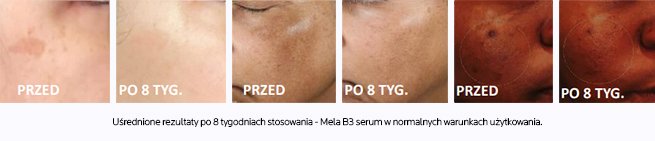 Czym jest i jak określić fototyp skóry? | La Roche-Posay